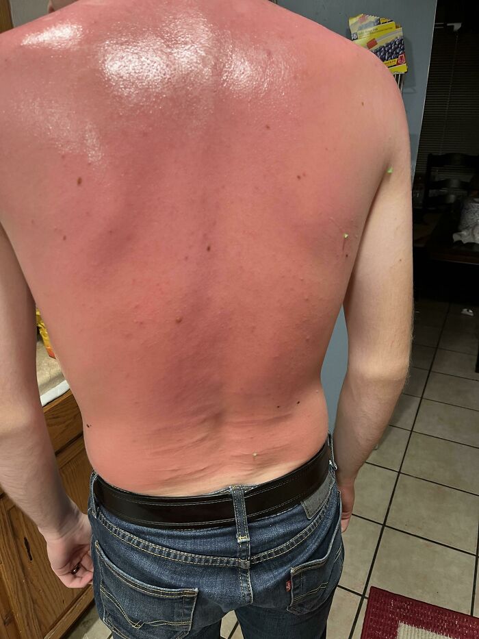See what happened to those who thought they didn't need sunscreen. (50 ...